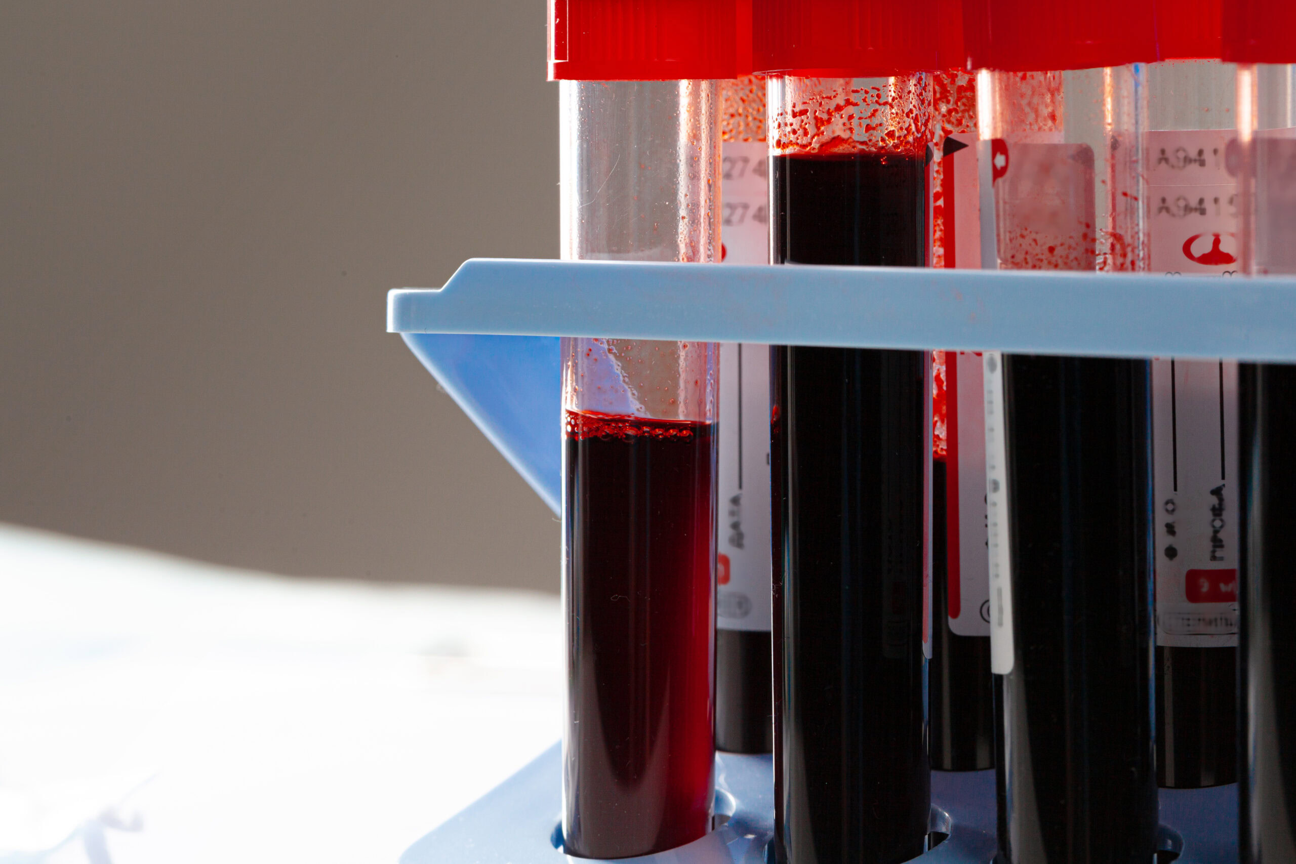 Vitesse de sédimentation élevée, pathologies et causes probables